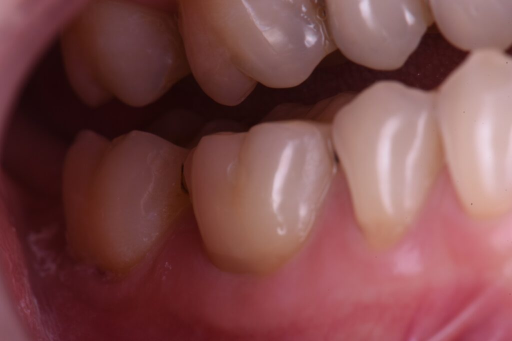 Sensitive root surfaces from overbrushing Sensitive root surfaces from ...