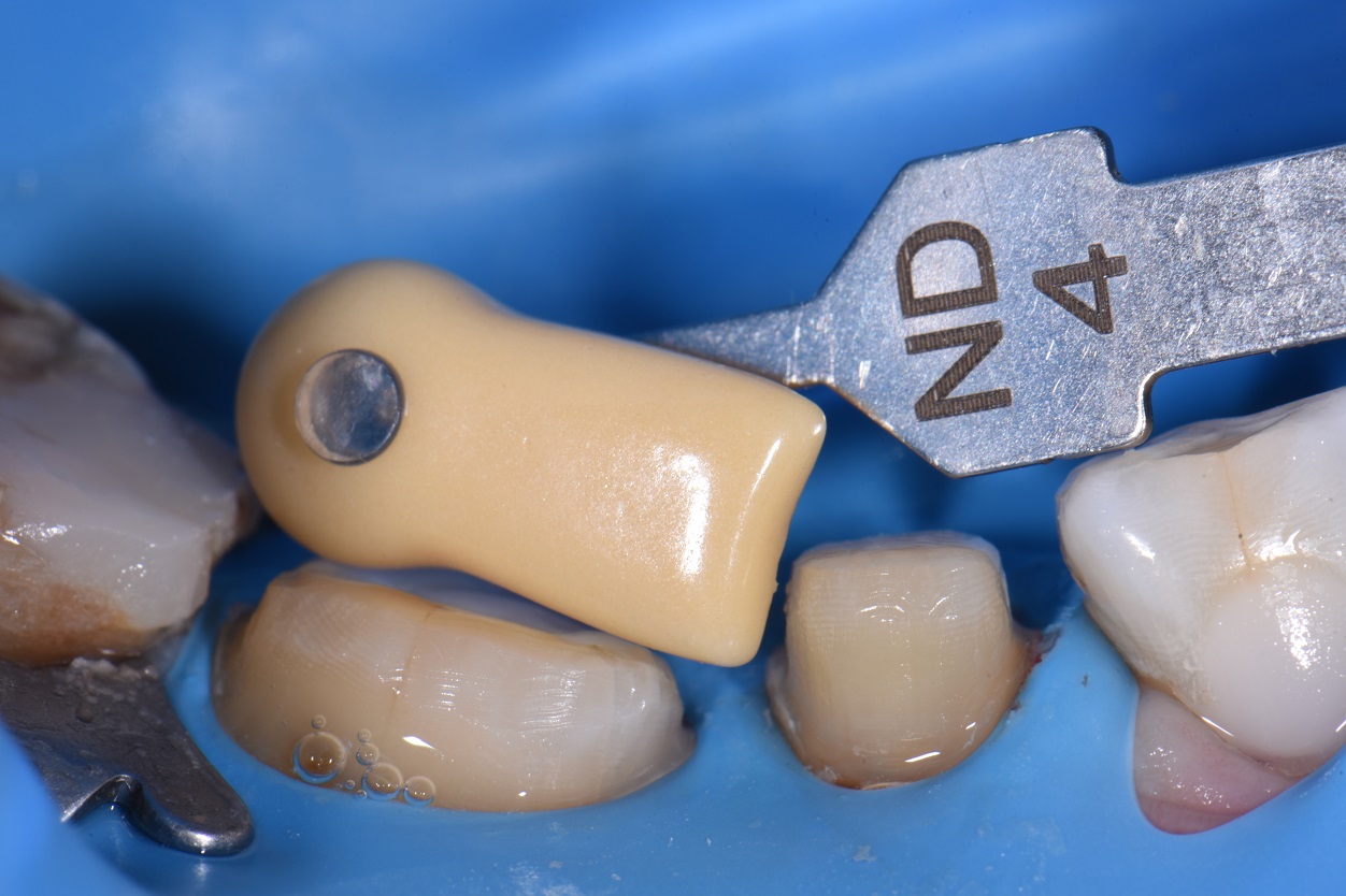 Rebuilding anatomy to jive with existing functional occlusion ...