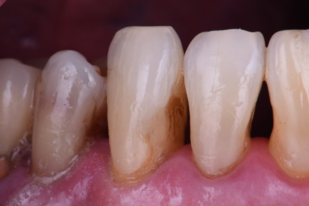 Correcting Abrasion and Root Irregularities Correcting Abrasion and ...