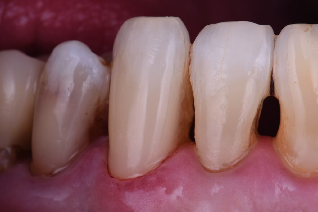 Correcting Abrasion and Root Irregularities Correcting Abrasion and ...