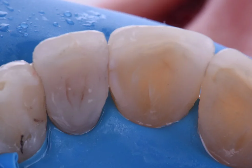 Garrison Fusion Anterior Matrix | Voco Grandio SO | Voco Final Touch ...