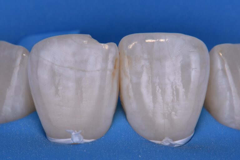 Garrison Fusion Anterior Freehand Class IV with Kerr Simplishade Light ...