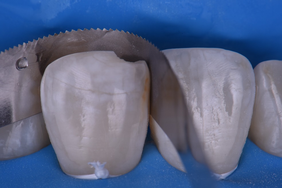 Garrison Fusion Anterior Freehand Class IV with Kerr Simplishade Light ...