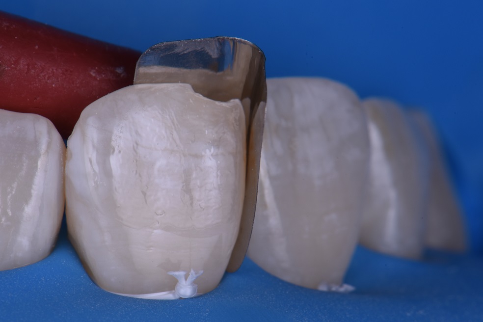 Garrison Fusion Anterior Freehand Class IV with Kerr Simplishade Light ...