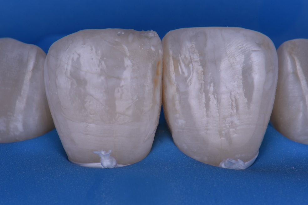 Garrison Fusion Anterior Freehand Class IV with Kerr Simplishade Light ...