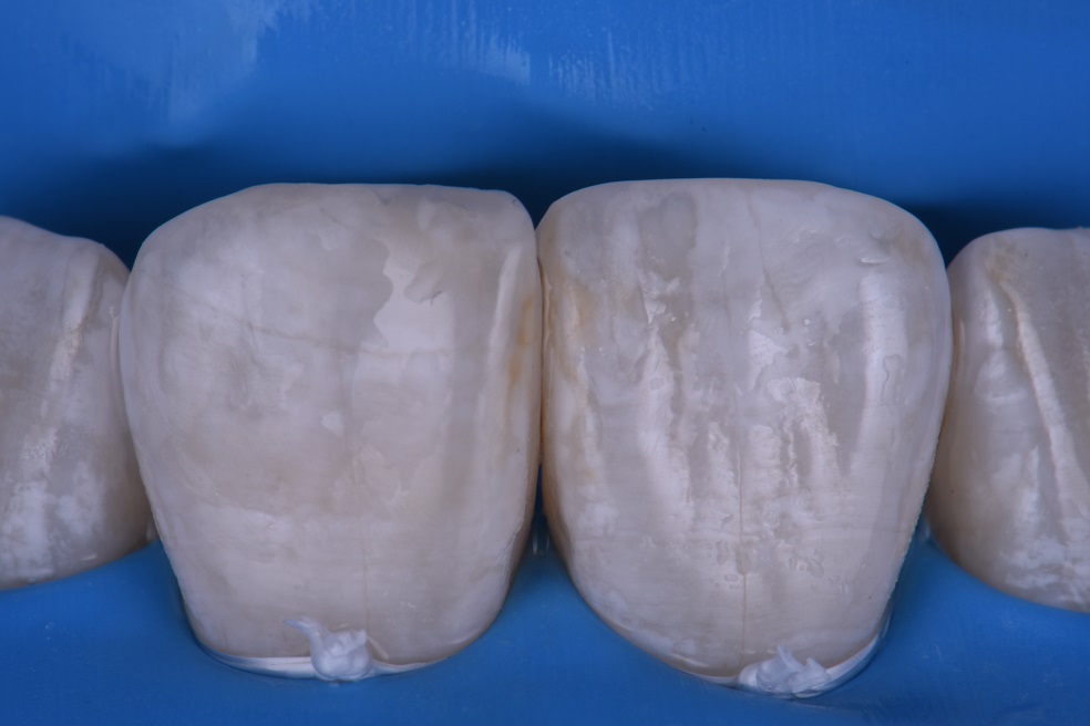 Garrison Fusion Anterior Freehand Class IV with Kerr Simplishade Light ...