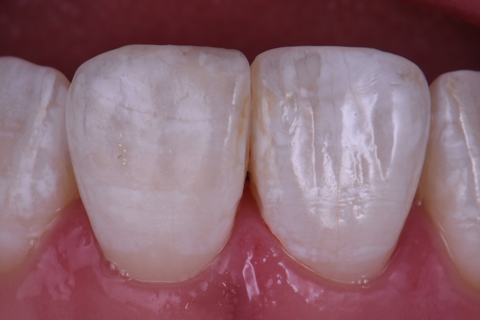 Garrison Fusion Anterior Freehand Class IV with Kerr Simplishade Light ...