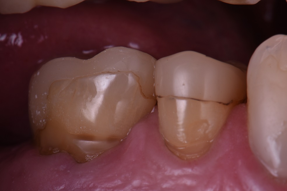 Cosmetic Fillings to block out dark root surfaces Cosmetic Fillings to ...