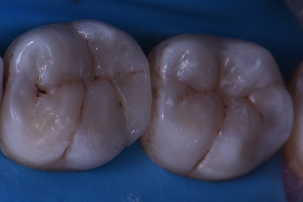 Emulating Nature in Everyday Composite Restorations Emulating Nature in ...