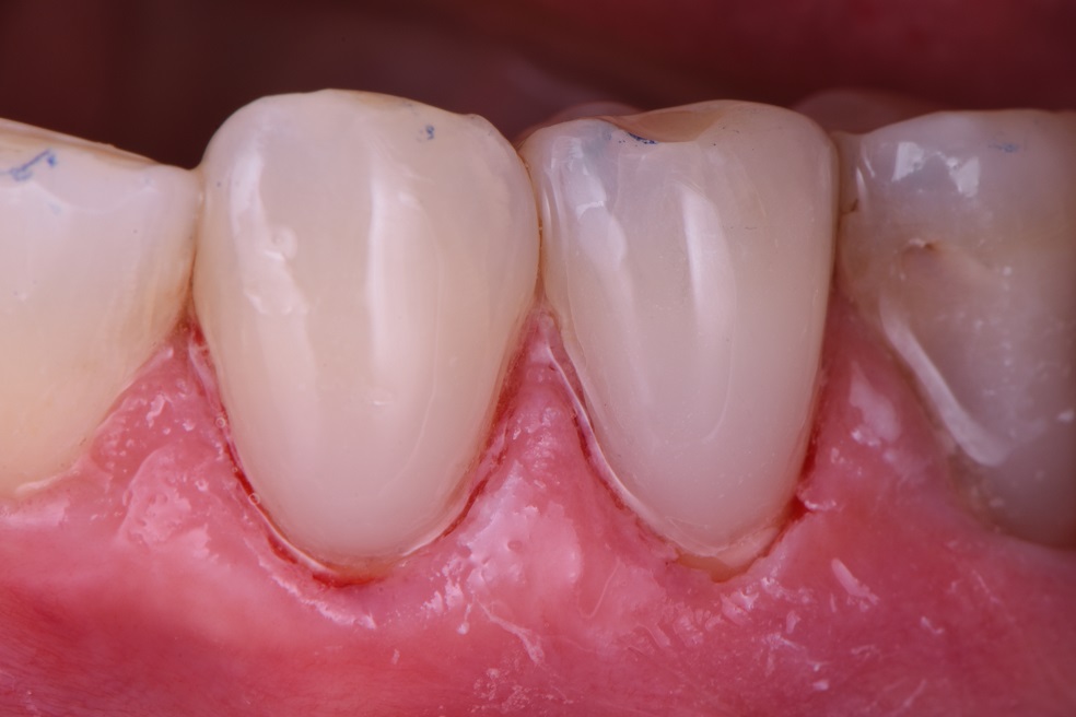 Large Class V lesions restored GC Essentia U Large Class V lesions ...