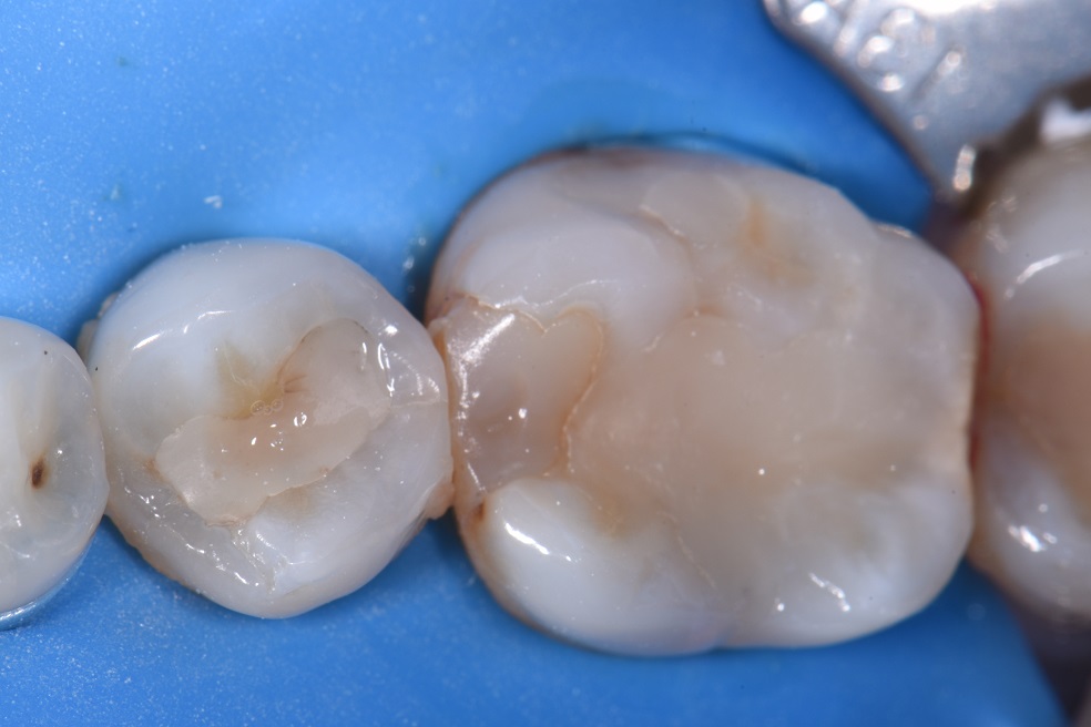 Ivoclar Tetric Prime Posterior Composite Anatomy Ivoclar Tetric Prime ...