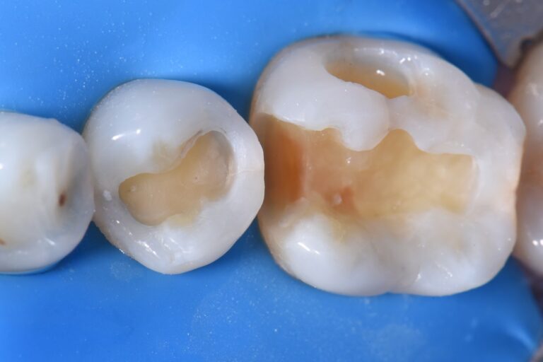 Ivoclar Tetric Prime Posterior Composite Anatomy Ivoclar Tetric Prime ...