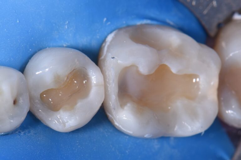 Ivoclar Tetric Prime Posterior Composite Anatomy Ivoclar Tetric Prime ...