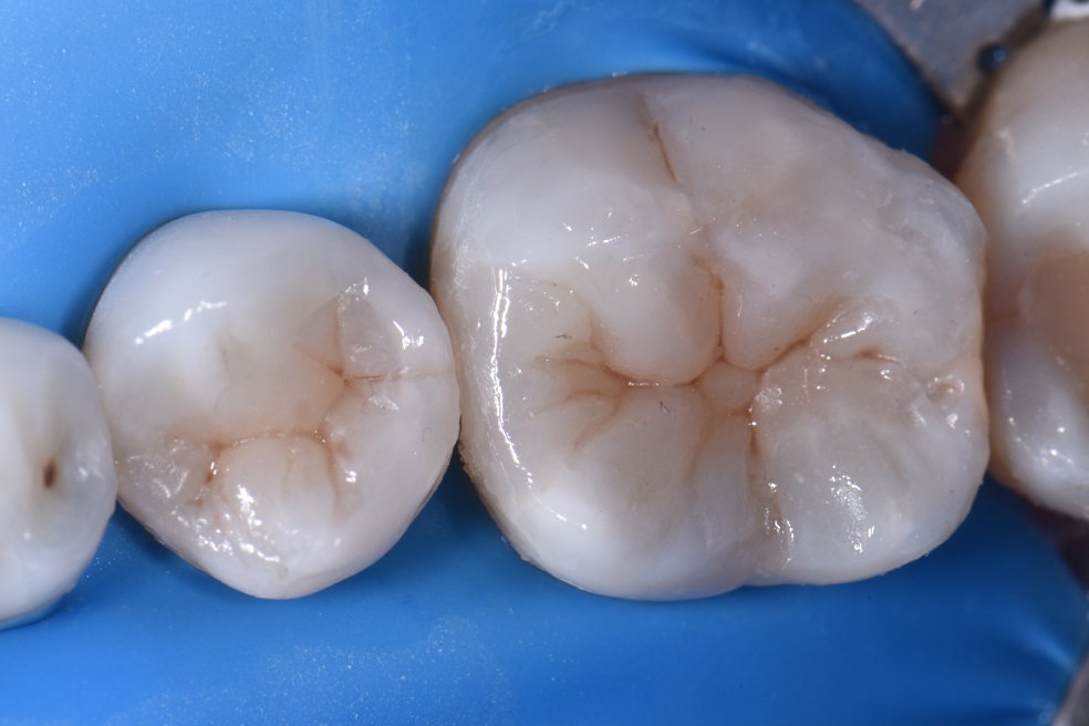 Ivoclar Tetric Prime Posterior Composite Anatomy Ivoclar Tetric Prime ...