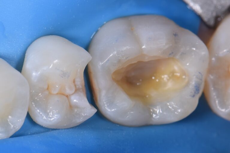 Ivoclar Tetric Prime Ivoclar Tetric Prime