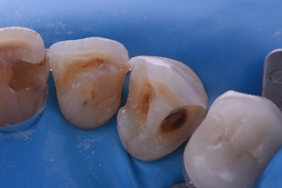 Class III resin restoration replacements Class III resin restoration ...