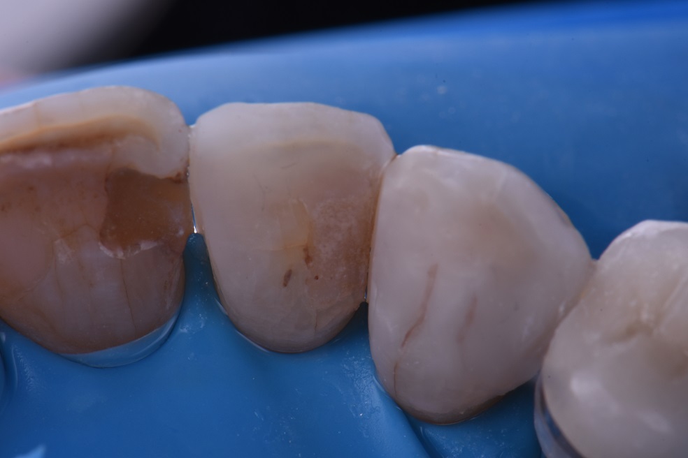 Class III resin restoration replacements Class III resin restoration ...