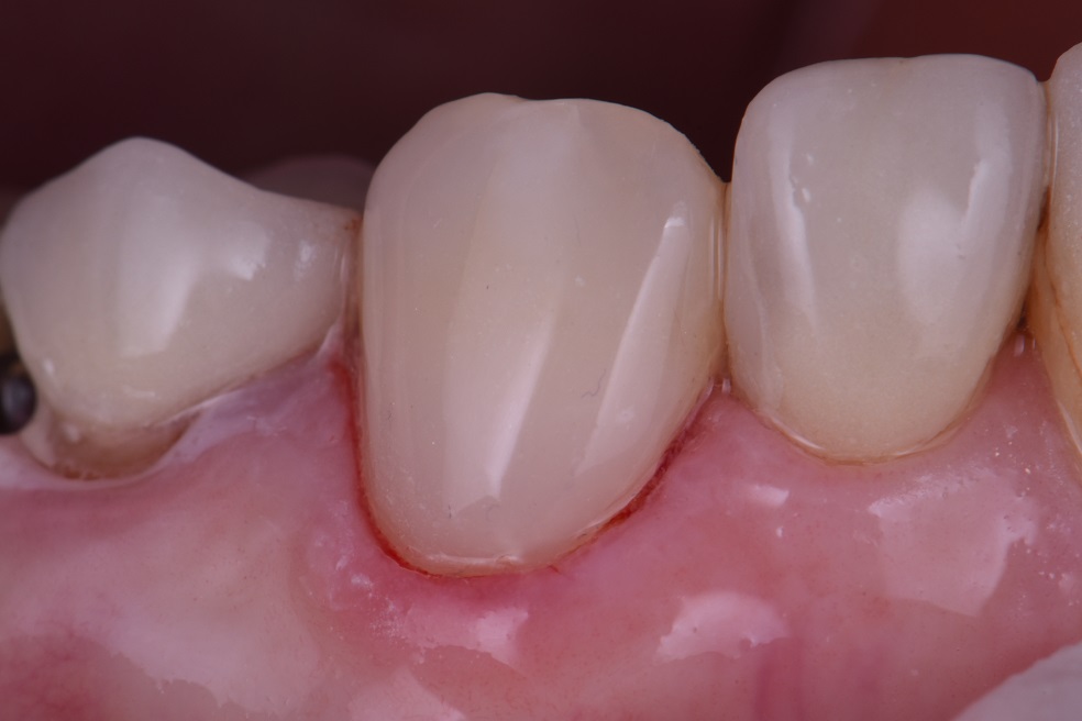 Recurrent decay around this old Class V composite filling Recurrent ...