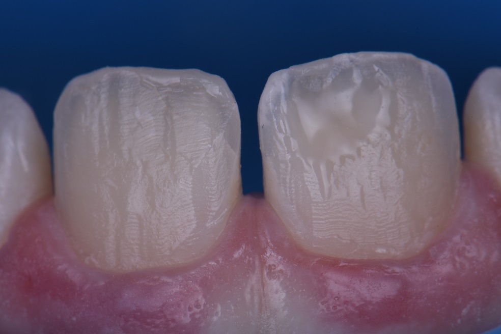Enamel Hypomineralization Treatment Bauer Smiles