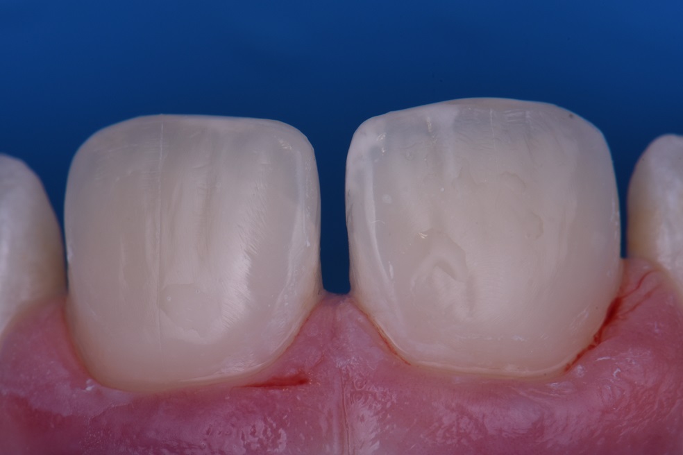 Enamel Hypomineralization Treatment Bauer Smiles