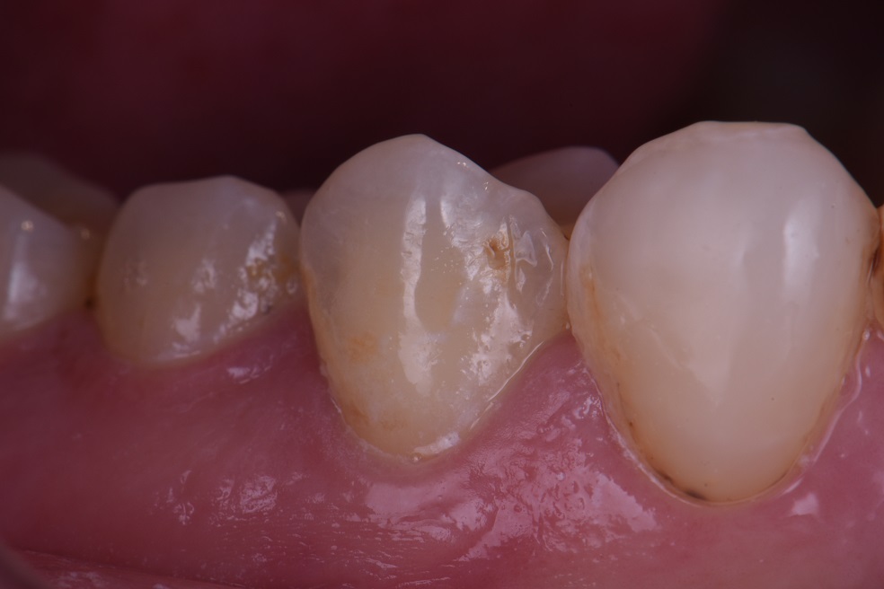 Brown pitted spots removed and restored with composite Brown pitted ...