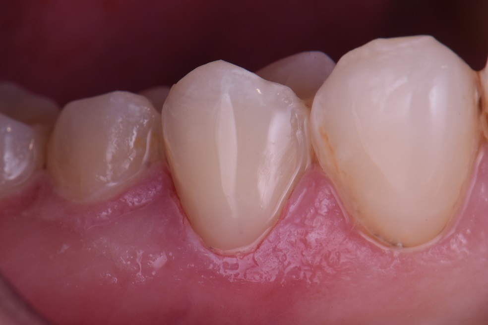 Brown pitted spots removed and restored with composite Brown pitted ...