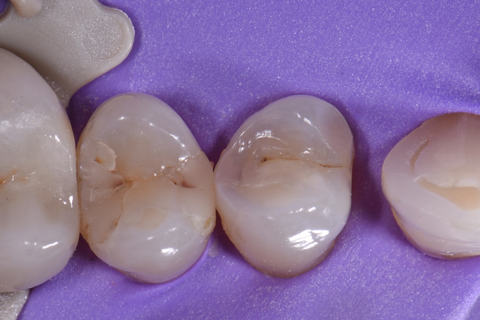 Kerr Soft Clamp | Simplishade | Clinicians Choice True Dam Kerr Soft ...