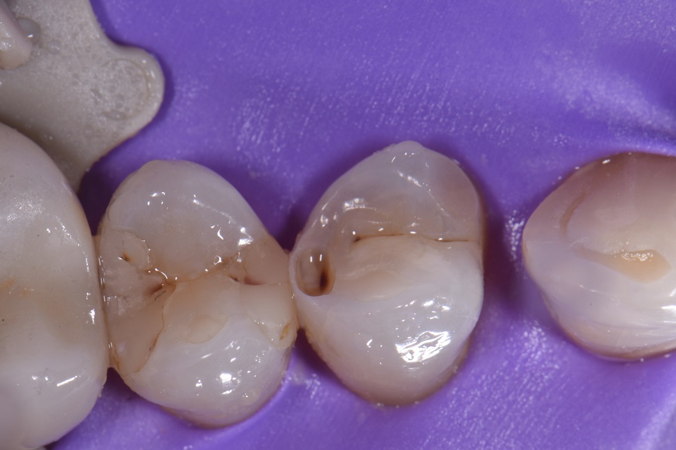 Kerr Soft Clamp | Simplishade | Clinicians Choice True Dam Kerr Soft ...