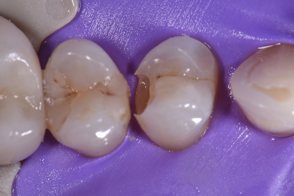 Kerr Soft Clamp | Simplishade | Clinicians Choice True Dam Kerr Soft ...