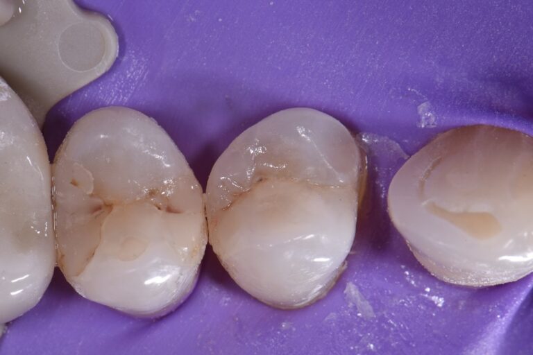 Kerr Soft Clamp | Simplishade | Clinicians Choice True Dam Kerr Soft ...