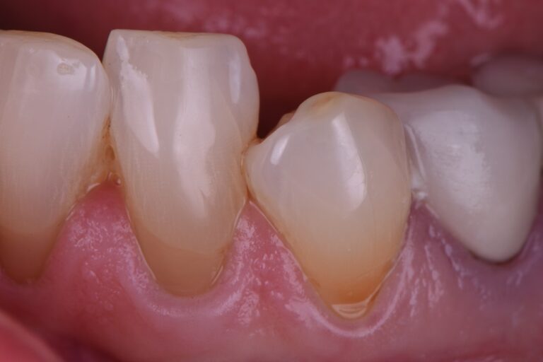 Root surface protection on a doctor Root surface protection on a doctor