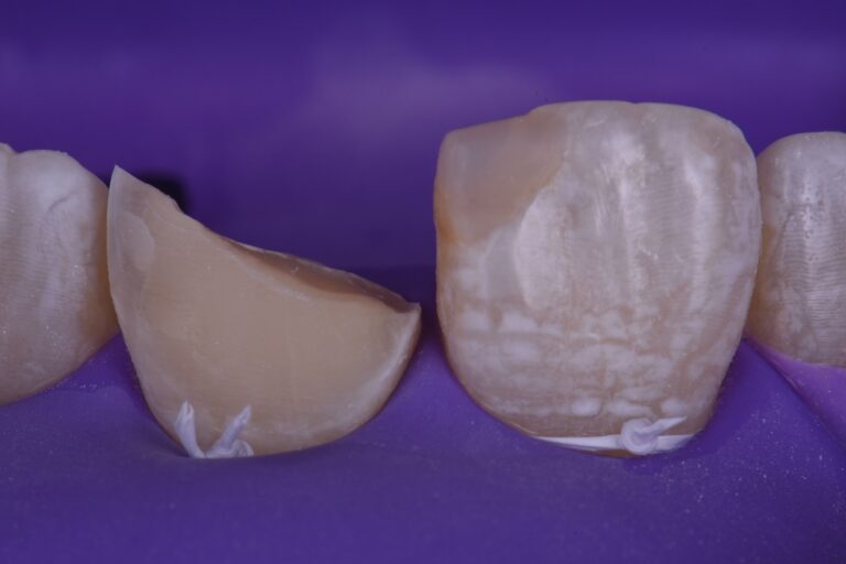 Class IV sequence Direct Composite Artistry Dehydrated Tooth Class IV ...