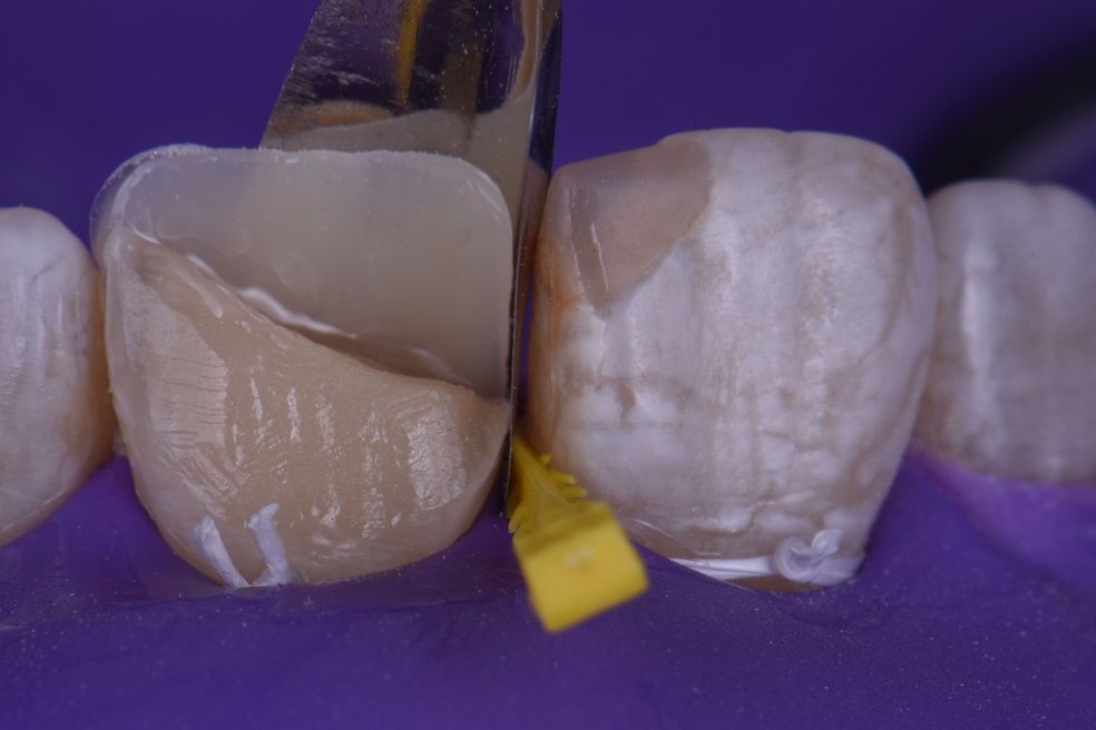Class IV sequence Direct Composite Artistry Dehydrated Tooth Class IV ...