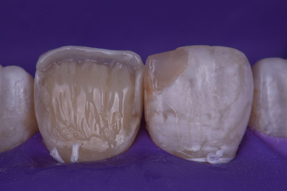 Class IV sequence Direct Composite Artistry Dehydrated Tooth Class IV ...