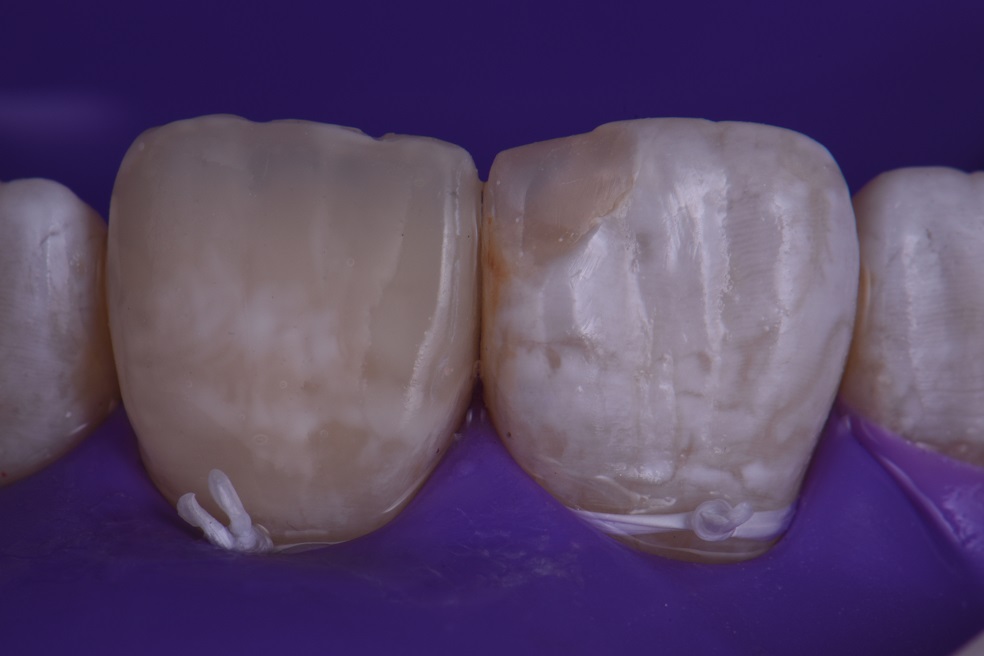 Class IV sequence Direct Composite Artistry Dehydrated Tooth Class IV ...