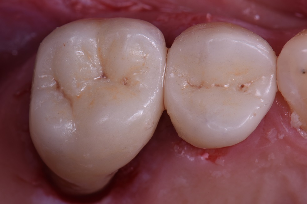 Old Crown Replacements with new bonded crowns Old Crown Replacements ...