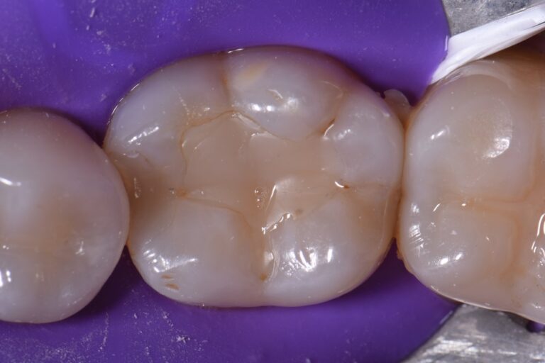 Deep cavities under old fillings Deep cavities under old fillings