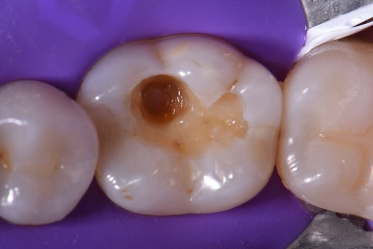 Deep cavities under old fillings Deep cavities under old fillings
