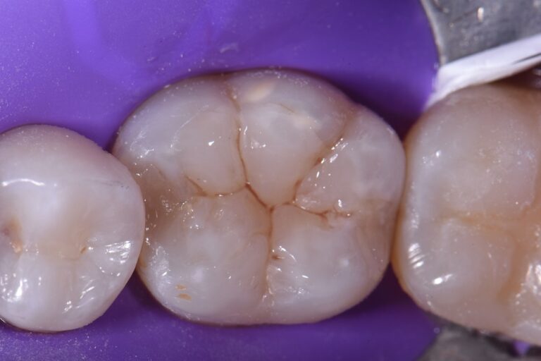 Deep cavities under old fillings Deep cavities under old fillings