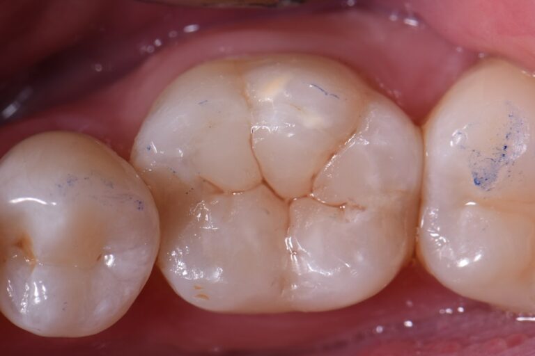 Deep cavities under old fillings Deep cavities under old fillings