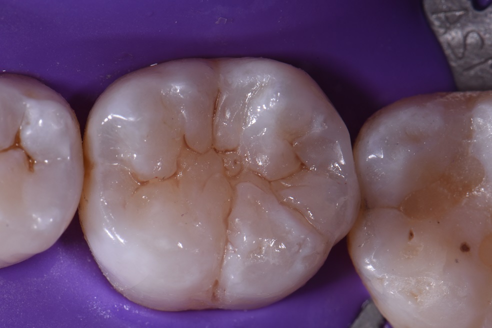 Microlayering a fissure sealant Microlayering a fissure sealant