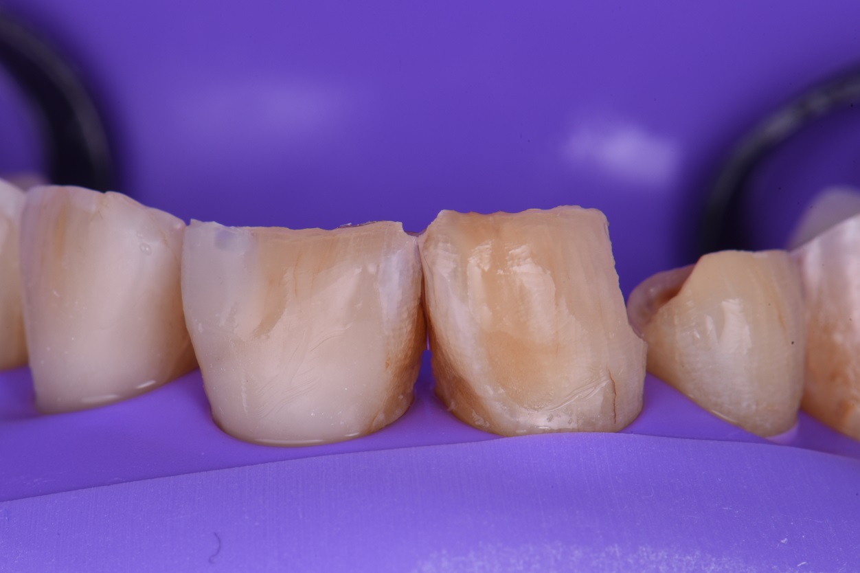 Minimally Invasive Composite Additions Minimally Invasive Composite ...