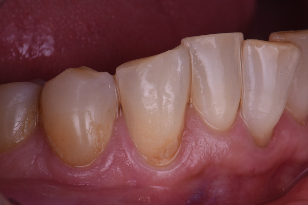 Dental whitening of yellow roots Dental whitening of yellow roots