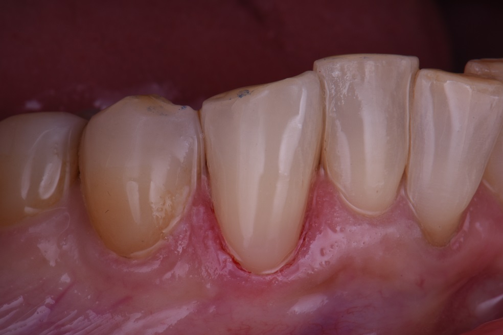 Dental whitening of yellow roots Dental whitening of yellow roots