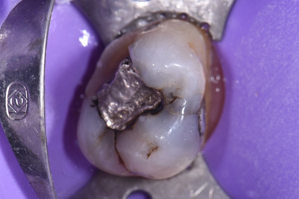 Bonded Dental Ceramic Overlays Bonded Dental Ceramic Overlays