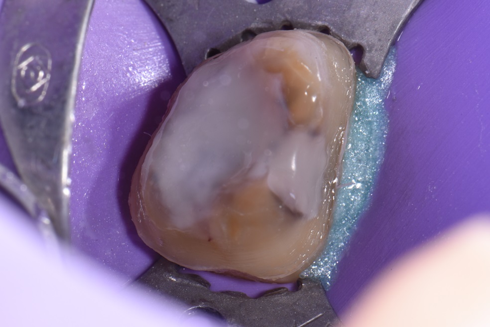Bonded Dental Ceramic Overlays Bonded Dental Ceramic Overlays
