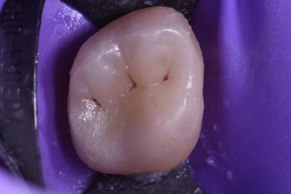 Bonded Dental Ceramic Overlays Bonded Dental Ceramic Overlays