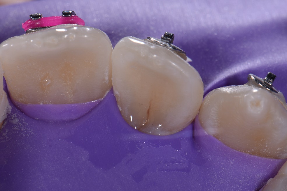 Dens Invaginatus Dens in dente restoration Dens Invaginatus Dens in ...