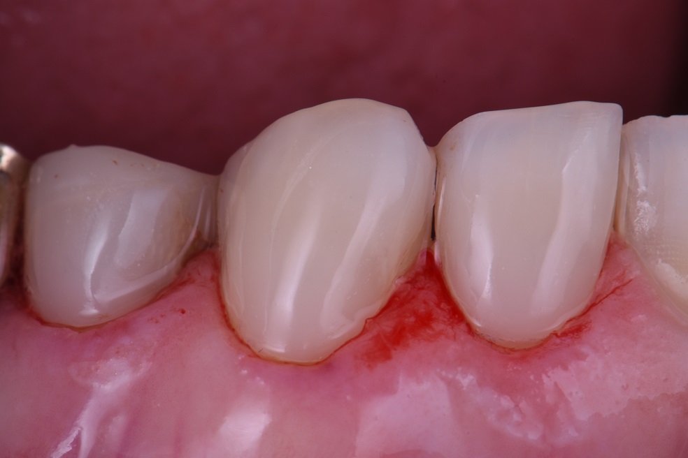 Restoring the worn necks of teeth Restoring the worn necks of teeth