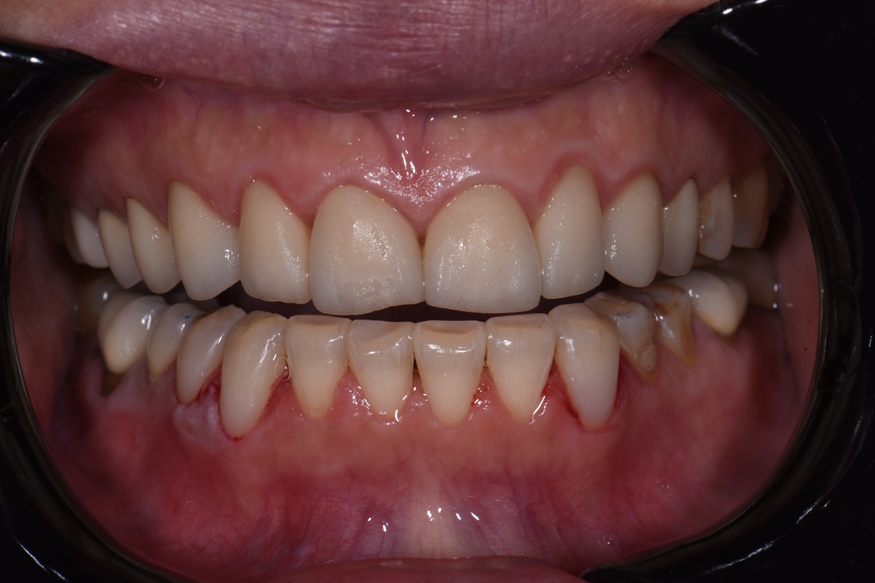 Noninvasive freehand composite resin bonding to protect Noninvasive ...